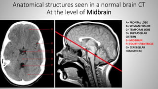 Midbrain Ct