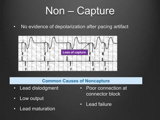Essentials of ecg interpretation aphrs | PPT
