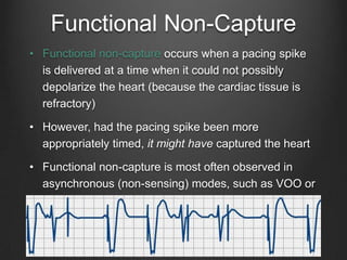 Essentials of ecg interpretation aphrs | PPT