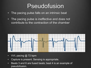 Essentials of ecg interpretation aphrs | PPT