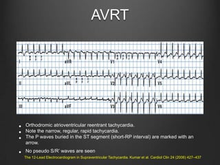 Essentials of ecg interpretation aphrs | PPT