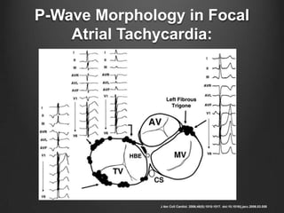 Essentials of ecg interpretation aphrs | PPT