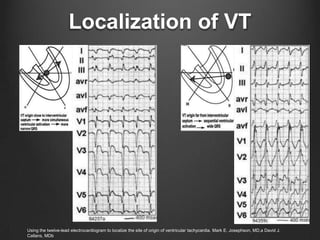 Essentials of ecg interpretation aphrs | PPT
