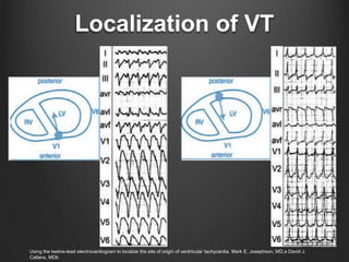 Essentials of ecg interpretation aphrs | PPT