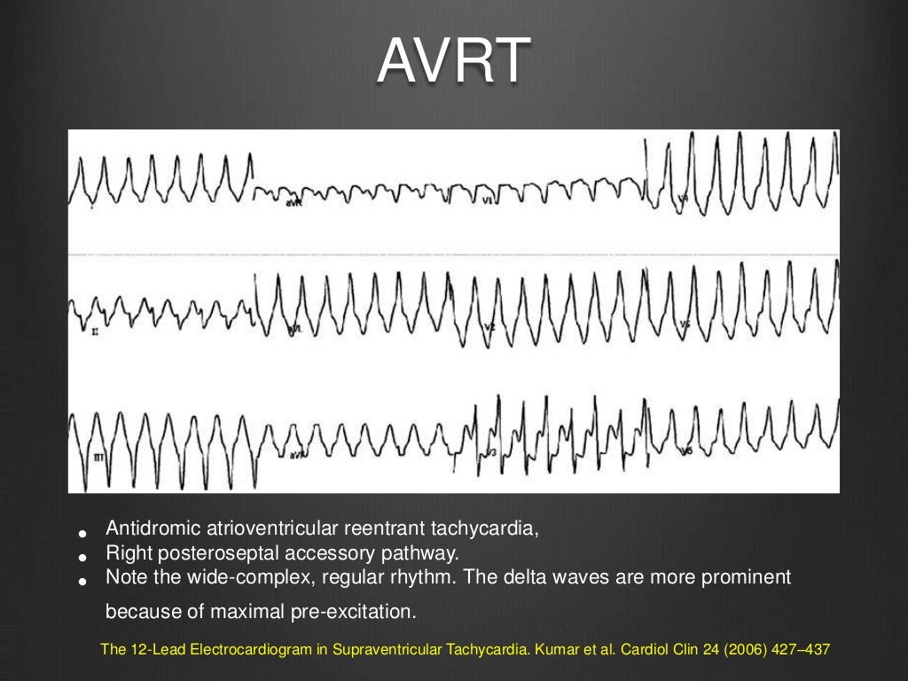 Essentials of ecg interpretation aphrs