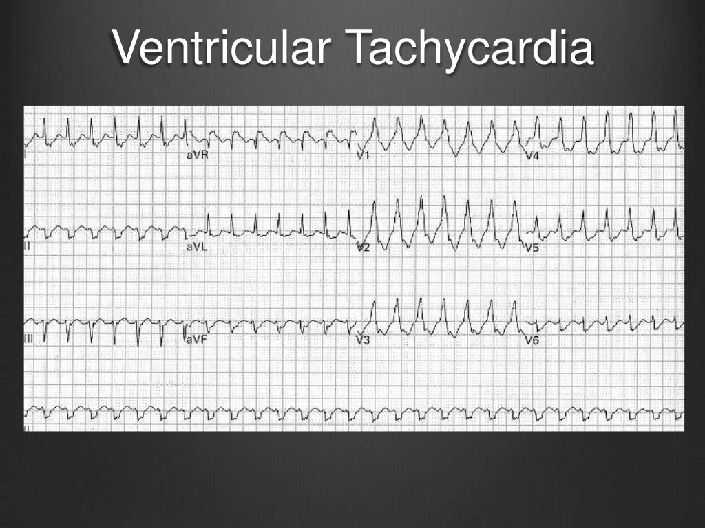 Essentials of ecg interpretation aphrs