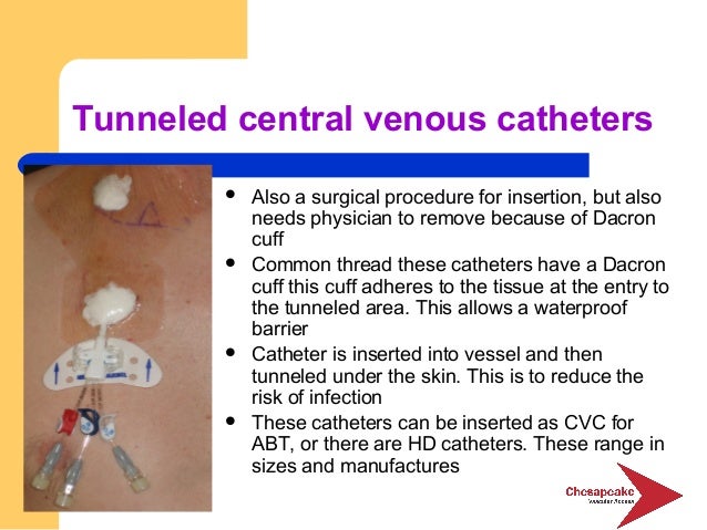 How A Tunnelled Central Line Is Placed Youtube