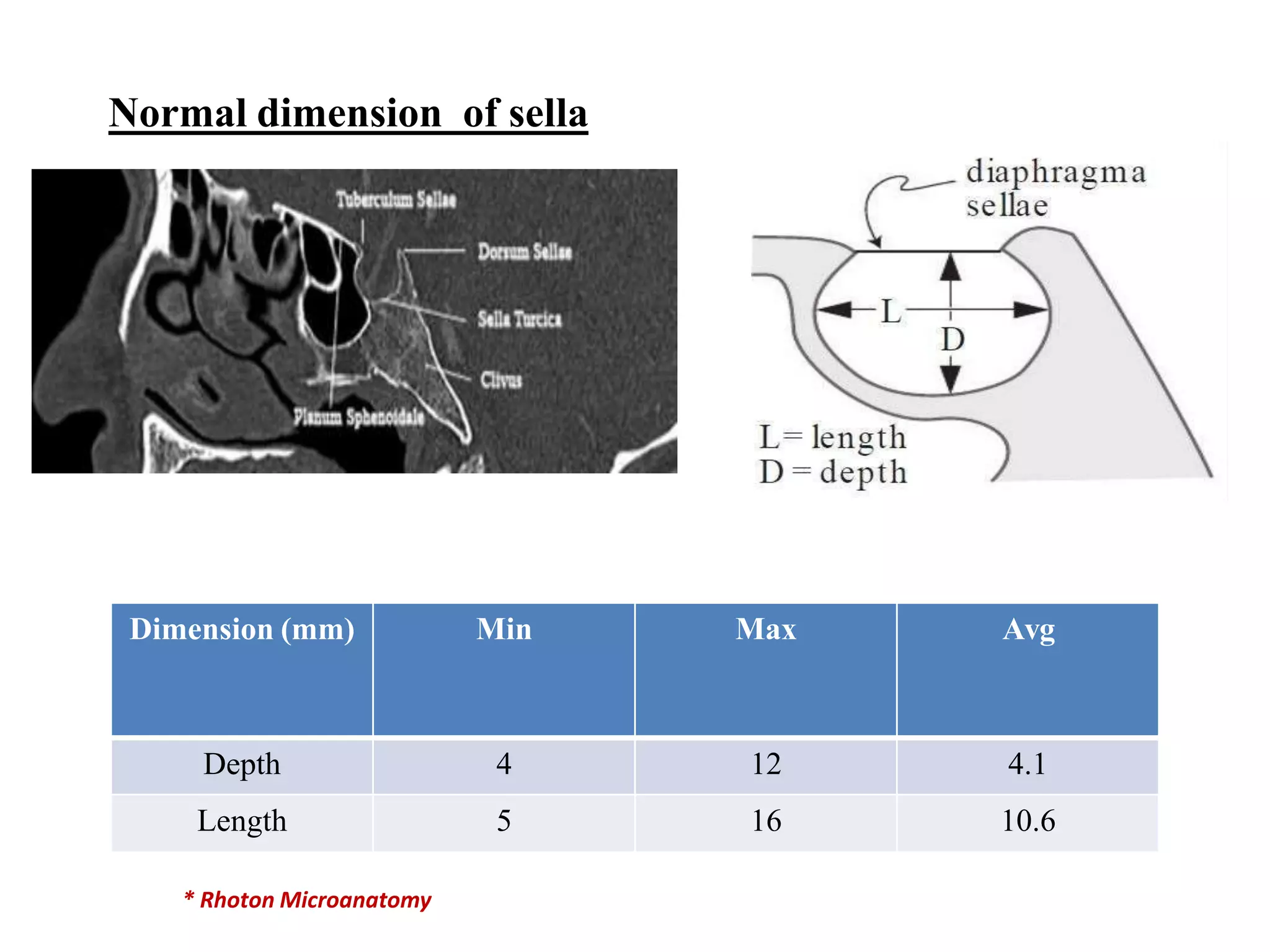 Empty sella syndrome | PPTX
