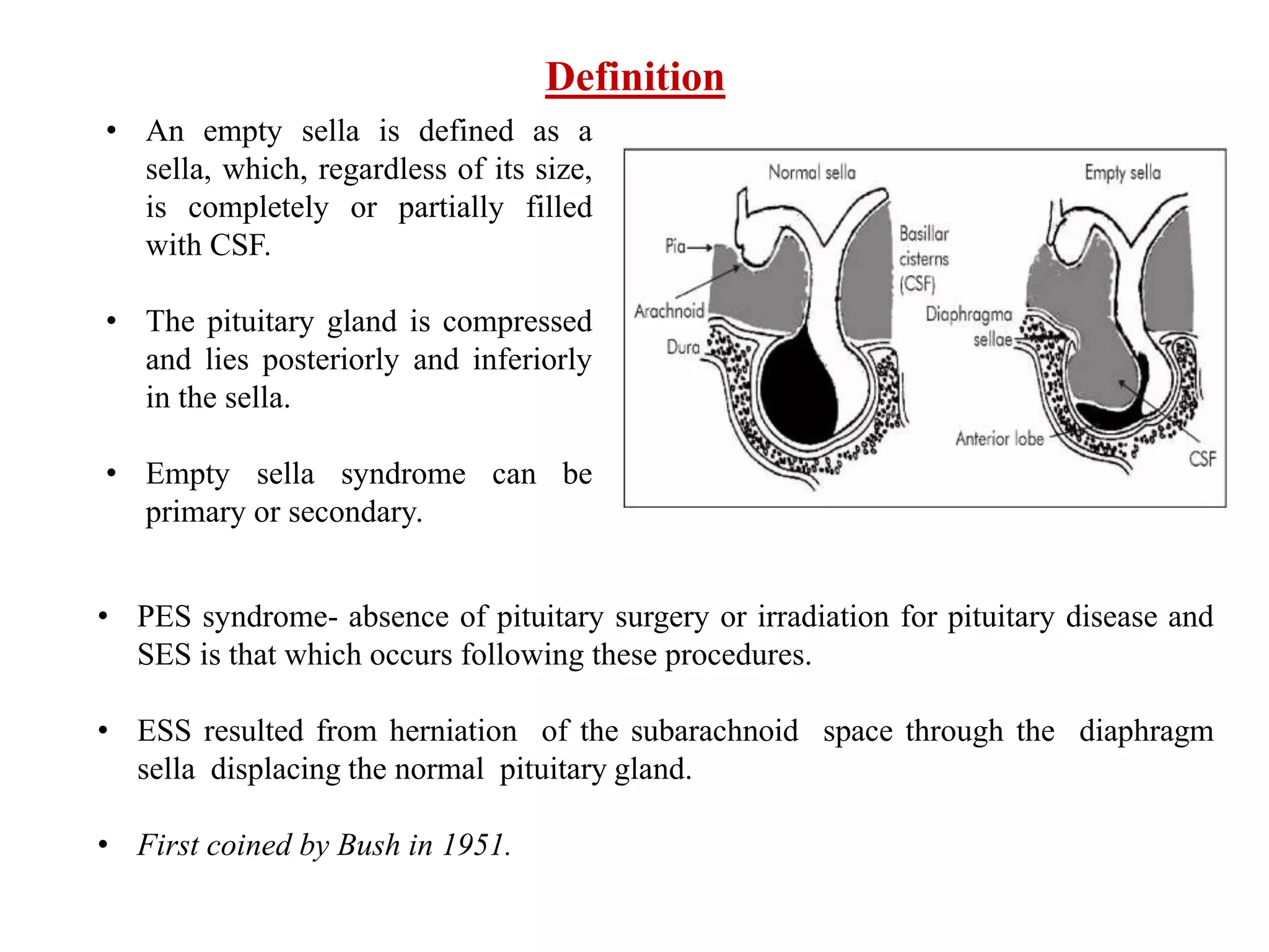 Empty sella syndrome | PPTX