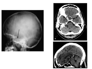 Empty sella syndrome | PPTX