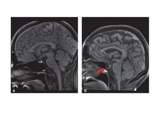 Empty sella syndrome | PPTX