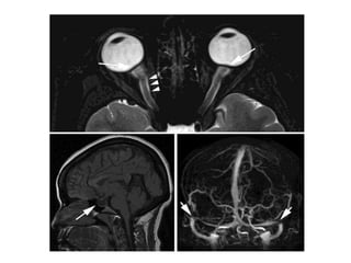 Empty sella syndrome | PPTX