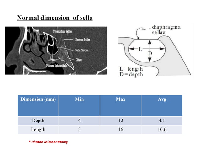 Empty sella syndrome | PPTX