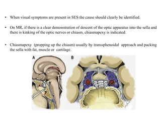 Empty sella syndrome | PPTX