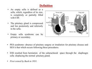 Empty sella syndrome | PPTX