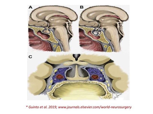 Empty sella syndrome | PPTX