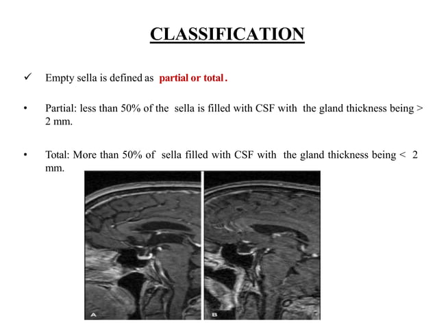 Empty sella syndrome | PPTX