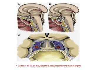 Empty Sella Turcica Diagram