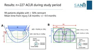 3D CT Evaluation Of Tunnel Positioning In ACL Reconstruction Using The ...