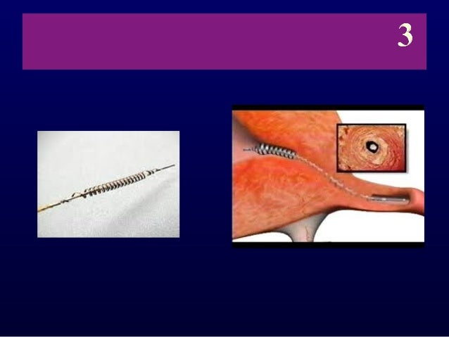 Essure (2)
