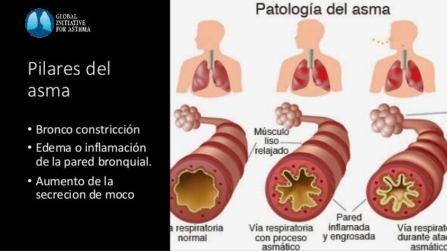 Estatus Asmatico 2017