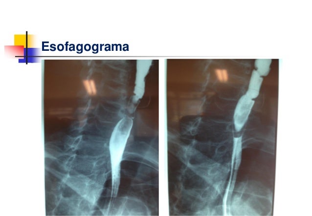 Estenose Esôfago Proximal