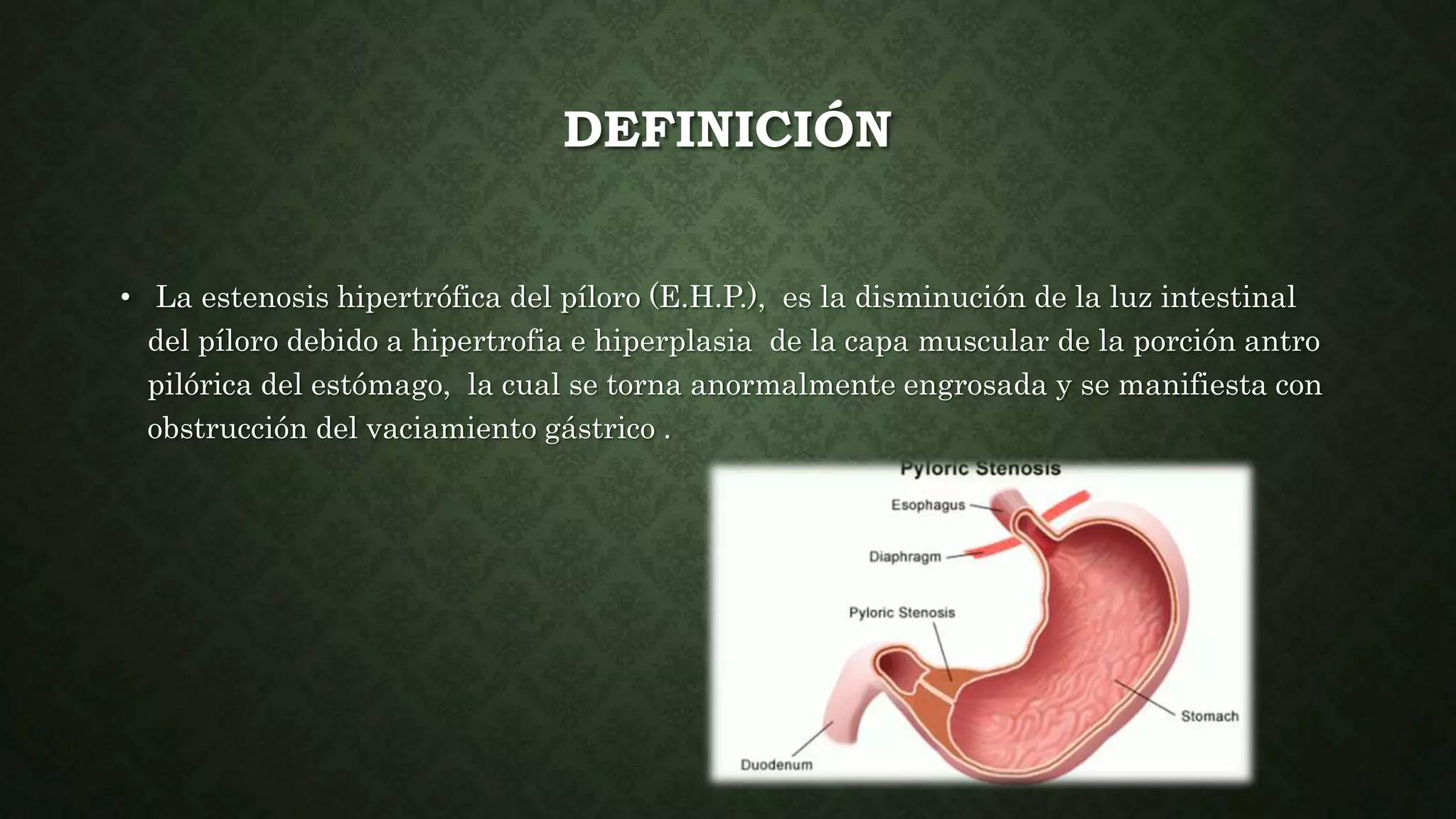 Estenosis hipertrófica-del-píloro | PPTX