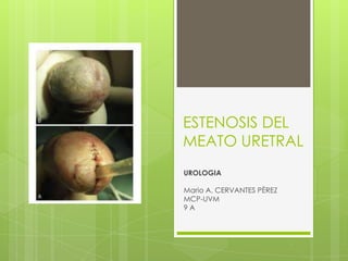 Estenosis del meato uretral | PPTX