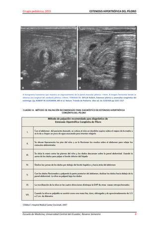 Estenosis hipertrófica del píloro | PDF
