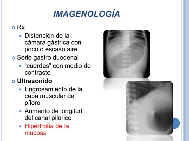 Estenosis hipertrófica del píloro | PPTX | Digestive Disorders ...
