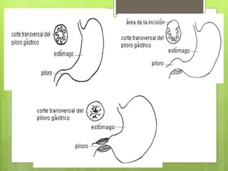 Estenosis hipertrofica del piloro | PPTX