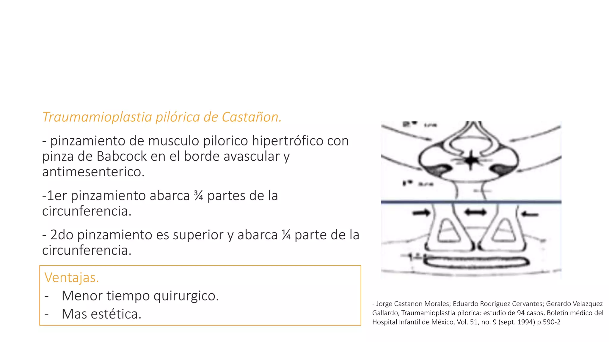 Estenosis hipertrofica del piloro | PPT