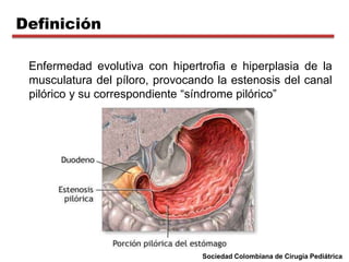 Estenosis hipertrofica de piloro | PPTX