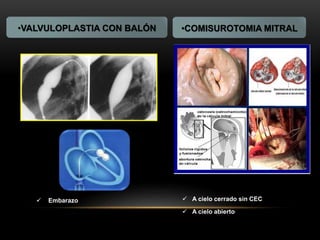 Estenosis Mitral Pptx