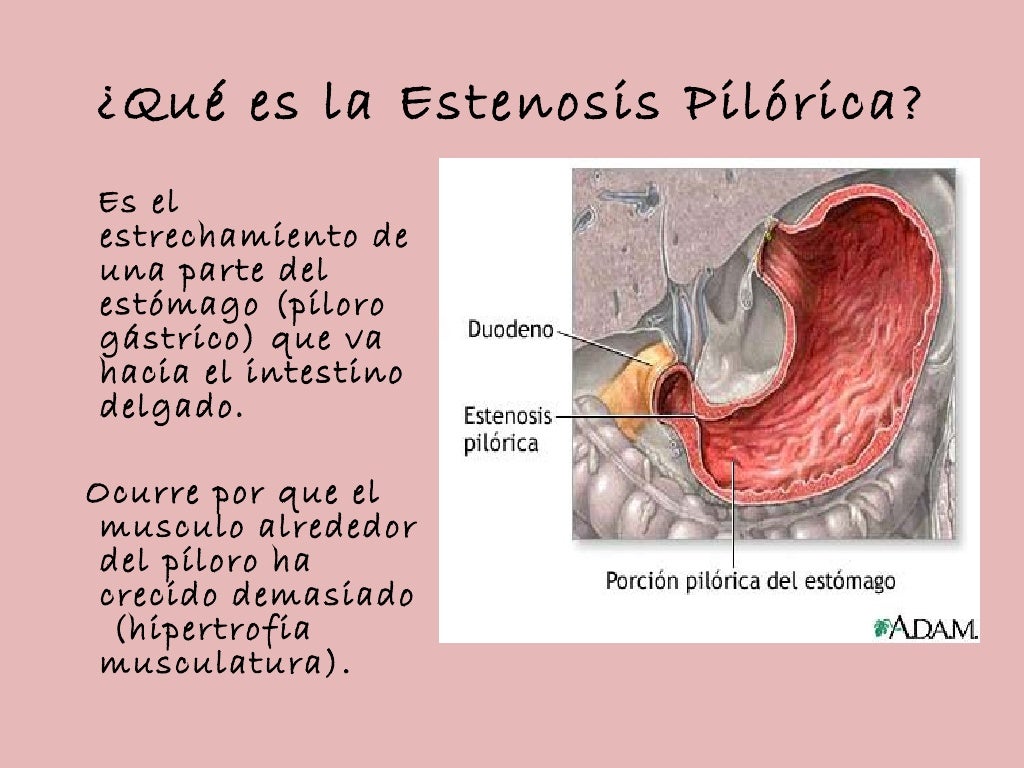 Estenosis pilorica