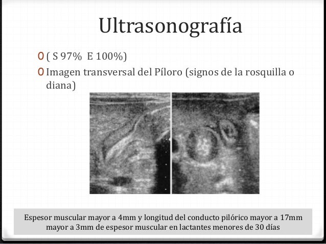Estenosis Pilórica Hipertrofica