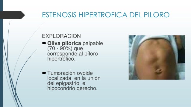 ESTENOSIS DE PILORO PRESENTACION