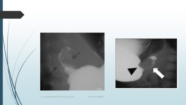 ESTENOSIS DE PILORO PRESENTACION