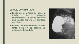 ESTENOSIS PILÓRICA -OBSTRUCCION INTESTINAL.pptx
