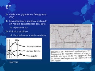 Estenosis pulmonar | PPTX