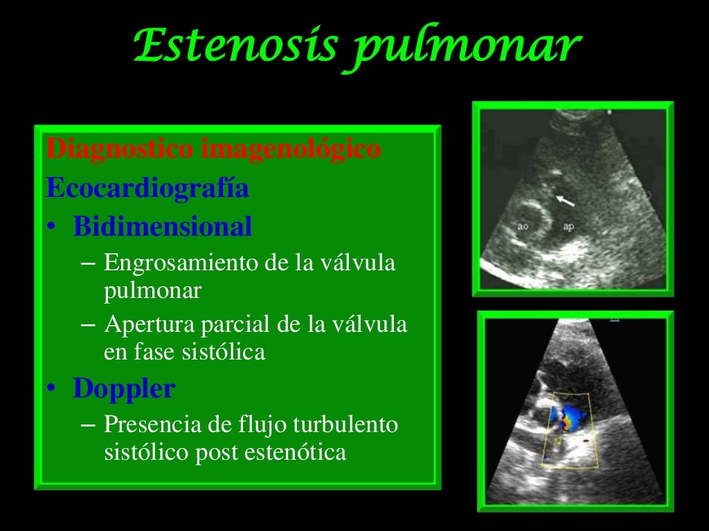 Estenosis pulmonar