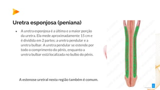 Estenosis Ureteral.Resumen Bibliográfico pptx.pptx