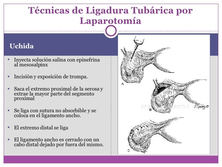 cirugia de laparoscopia