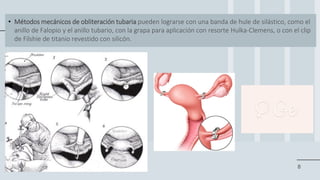 Esterilización quirúrgica femenina by Sócrates Pozo | PDF