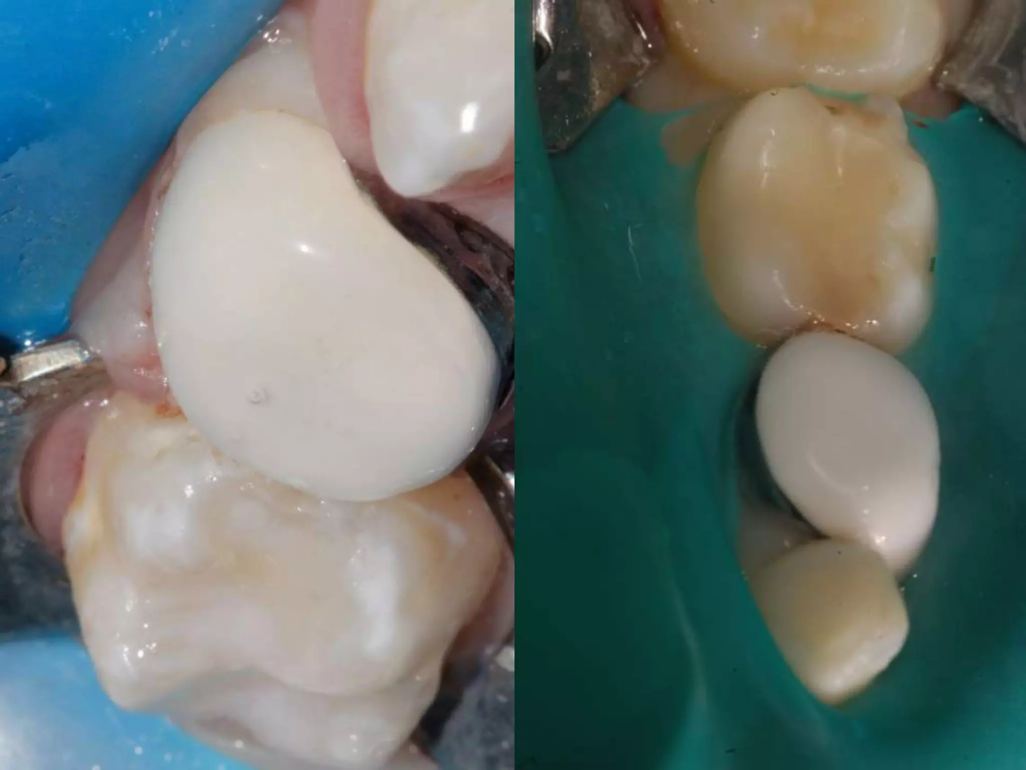 Esthetic crowns for posterior primary teeth | PPTX
