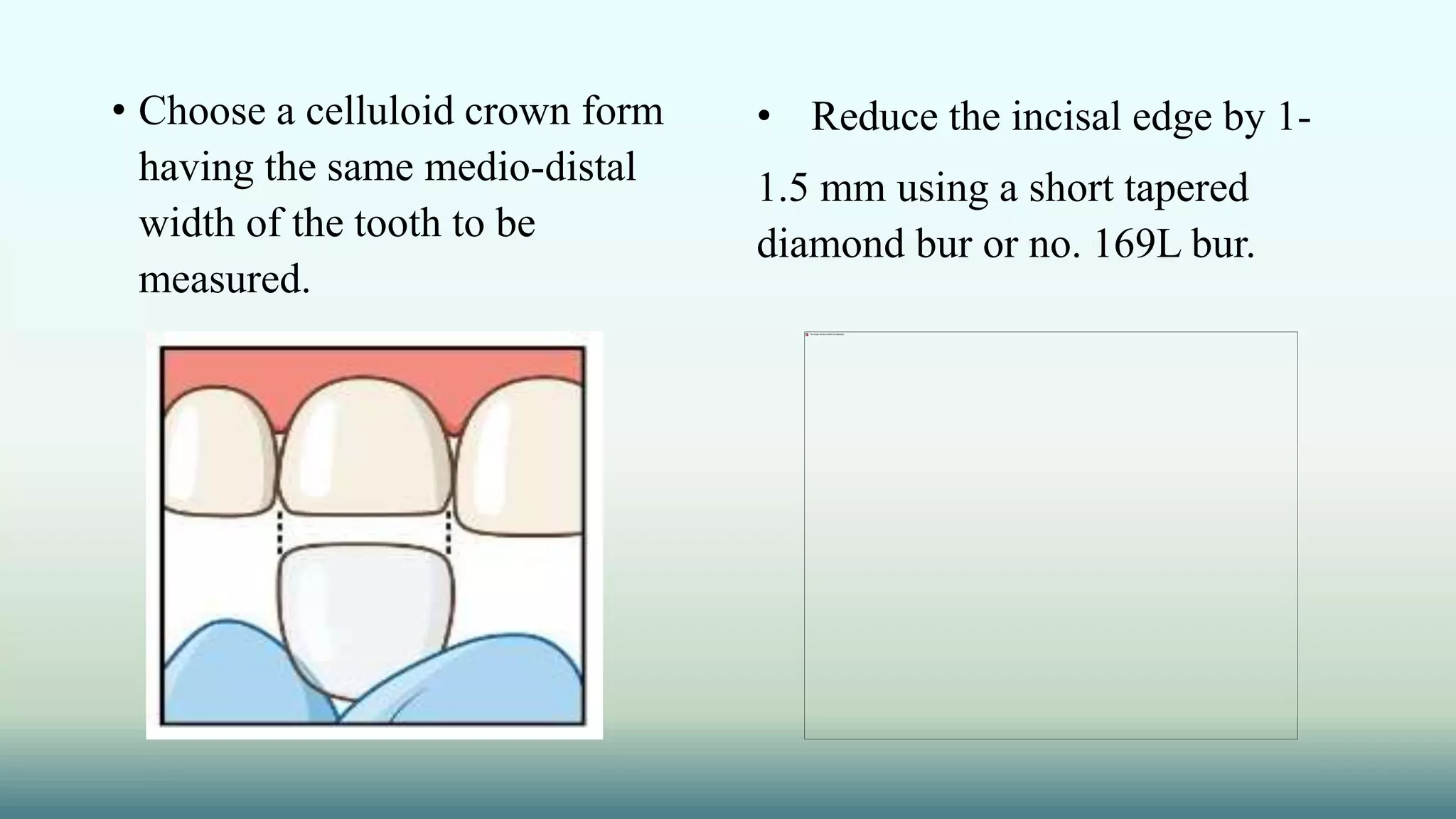 Esthetic crowns in pediatric dentistry.pptx