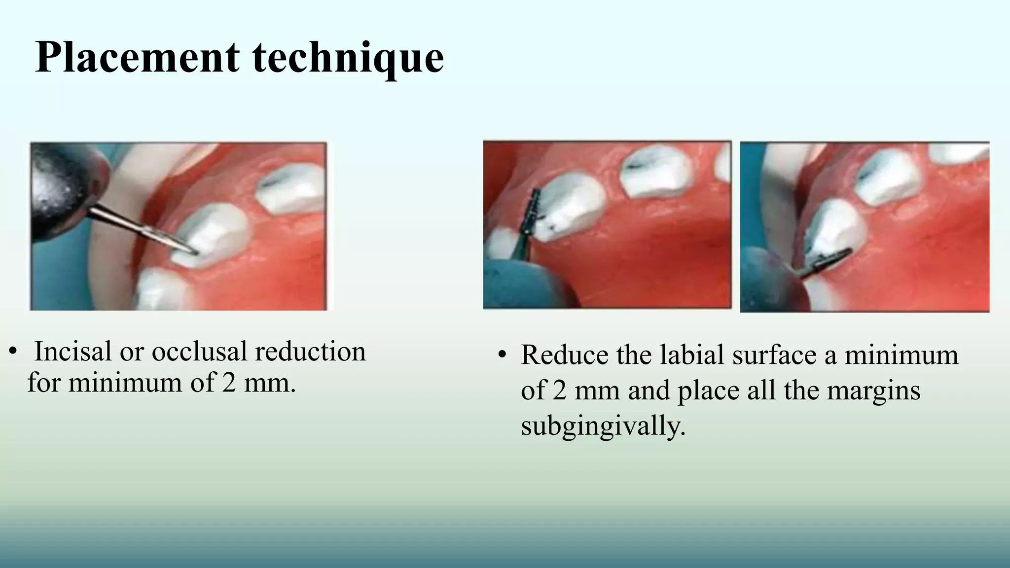 Esthetic crowns in pediatric dentistry.pptx