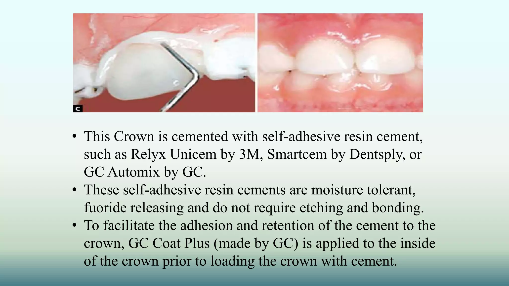 Esthetic crowns in pediatric dentistry.pptx