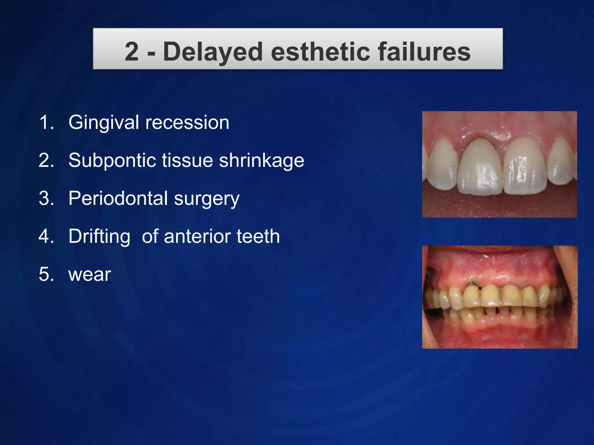 Esthetic failure of bridge | PPTX