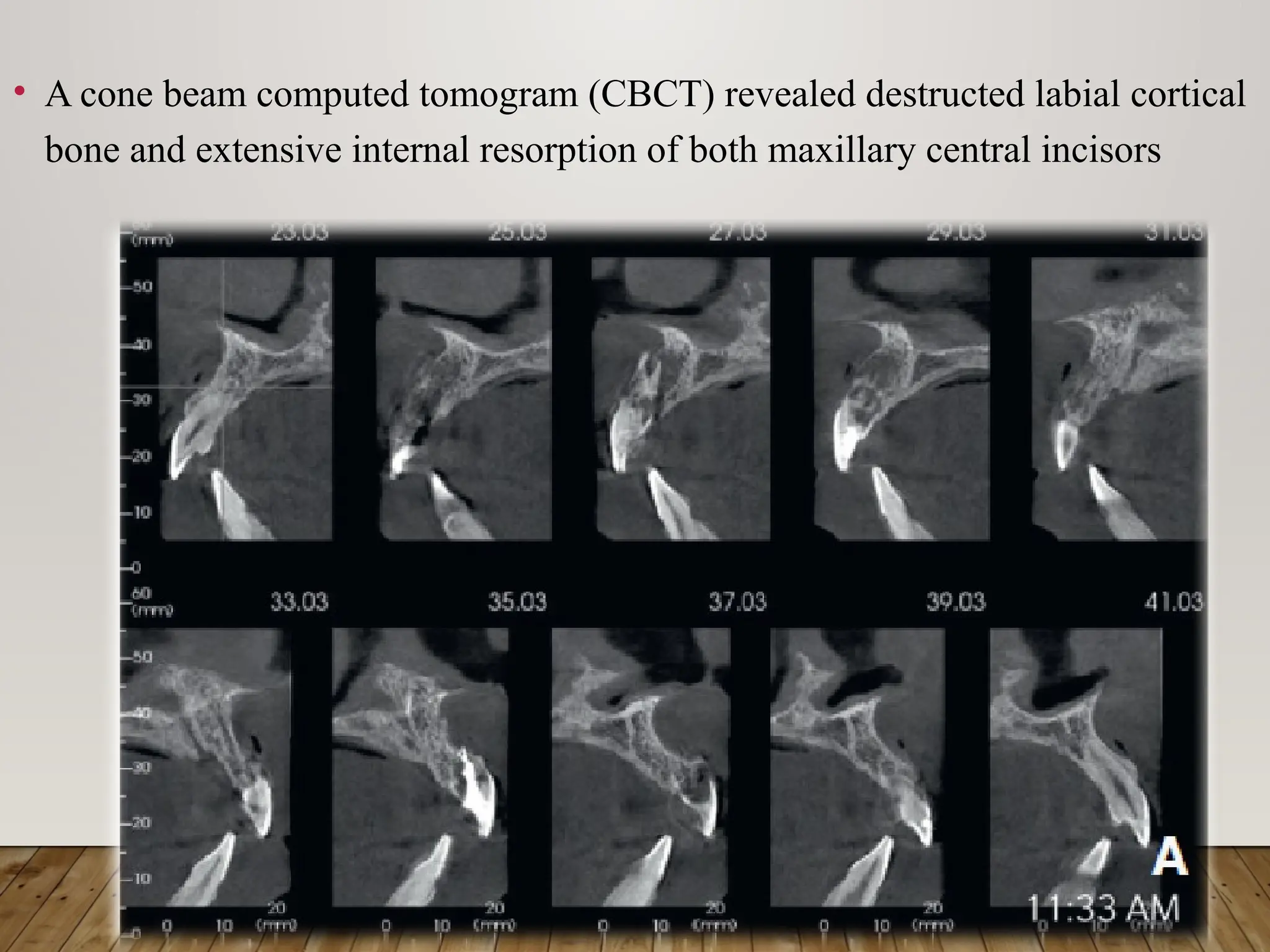 Esthetic rehabilitation of mutilated maxillary anterior alveolar ...